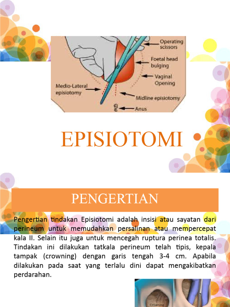 Episiotomi | PDF