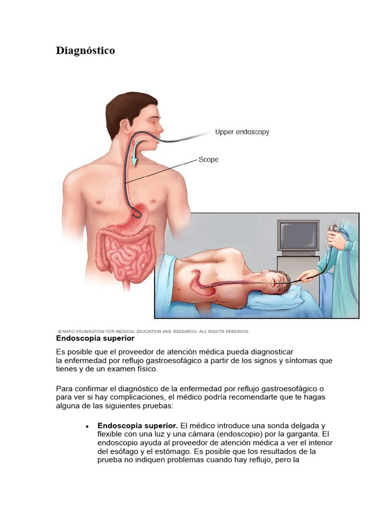 Diagnostico de Las Erges | PDF | Esófago | Endoscopia