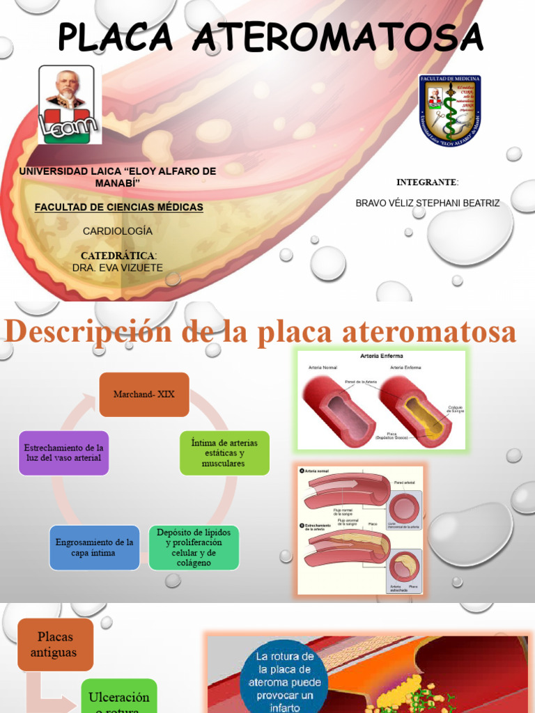 Placa Ateromatosa: Causas y Riesgos | PDF | Ateroma | Isquemia
