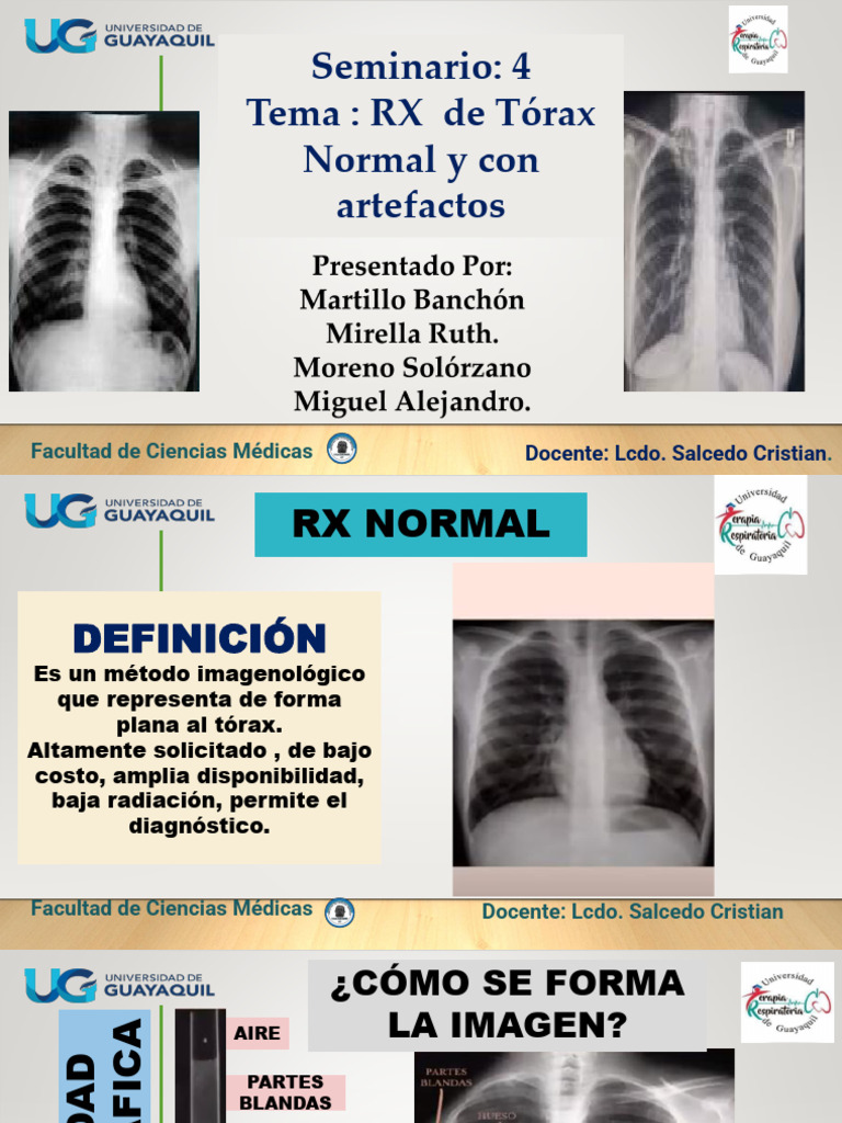 RX de Tórax Normal y Con Artefactos | PDF | Corazón | Aorta