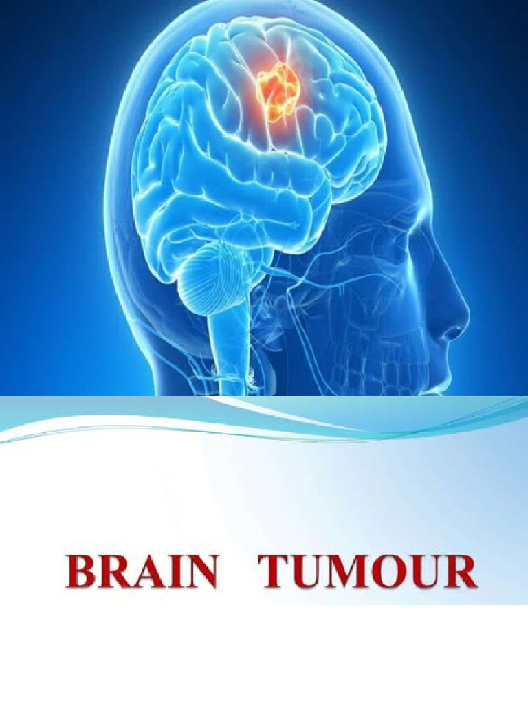 Brain Tumors | PDF