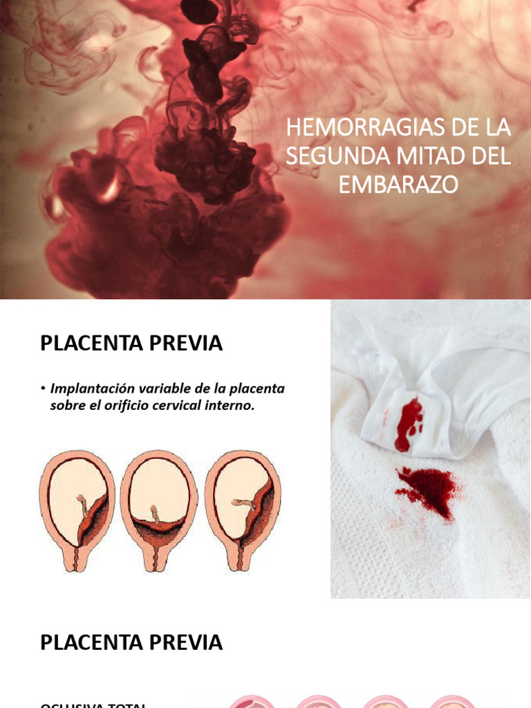 Hemorragias y Placenta Previa en Embarazo | PDF | Placenta | Parto