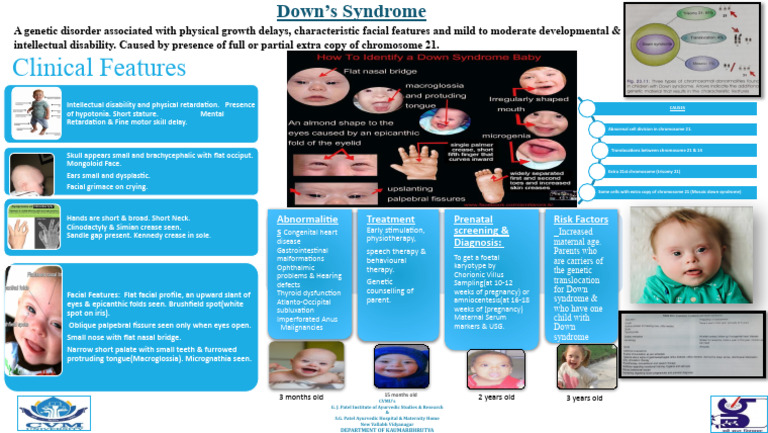 Down's Syndrome | Download Free PDF | Down Syndrome | Clinical Medicine