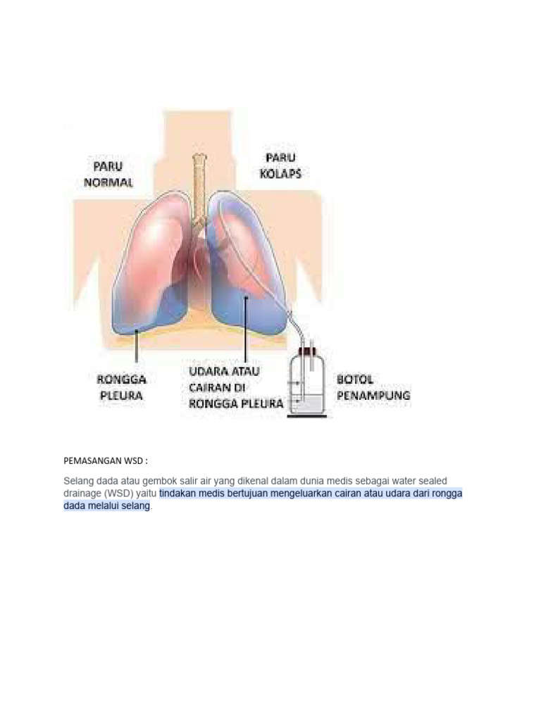 Pemasangan WSD | PDF Pemasangan WSD | PDF