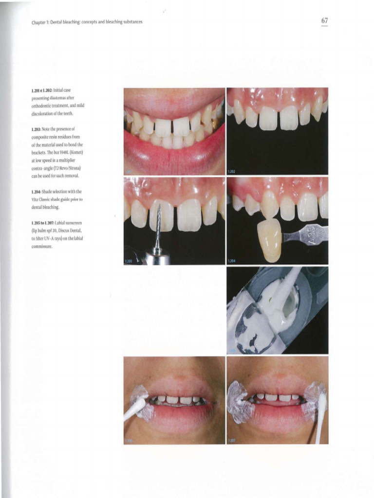 Shortcuts in Esthetic Dentistry Compressed 1 - Part2 | PDF | Dentistry ...