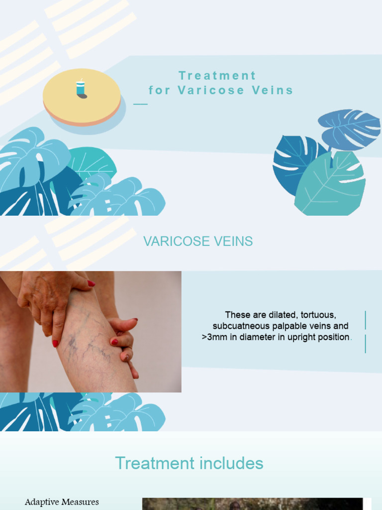 Treatment of varicose veins | PDF