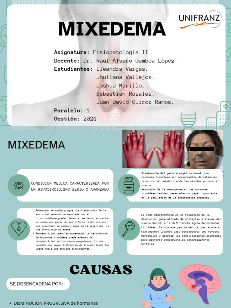 Mixedema - Presentación (Fisp Ii) | PDF | Tiroides | Hormona