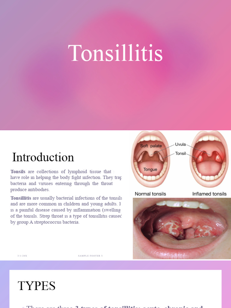 Tonsillitis | PDF | Pneumonia | Diseases And Disorders