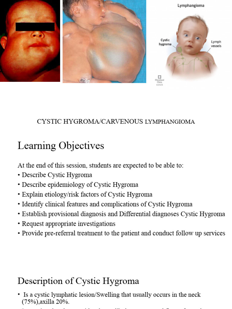 Session 7-CYSTIC HYGROMA | PDF | Diseases And Disorders | Causes Of Death