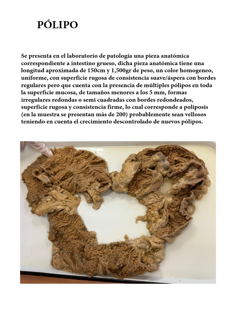 Poliposis Intestinal: Análisis Patológico | PDF | Cocina, comidas y vino