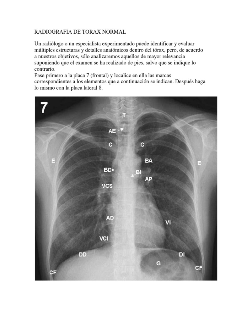 Radiografia de Torax Normal | PDF | Pulmón | Tórax
