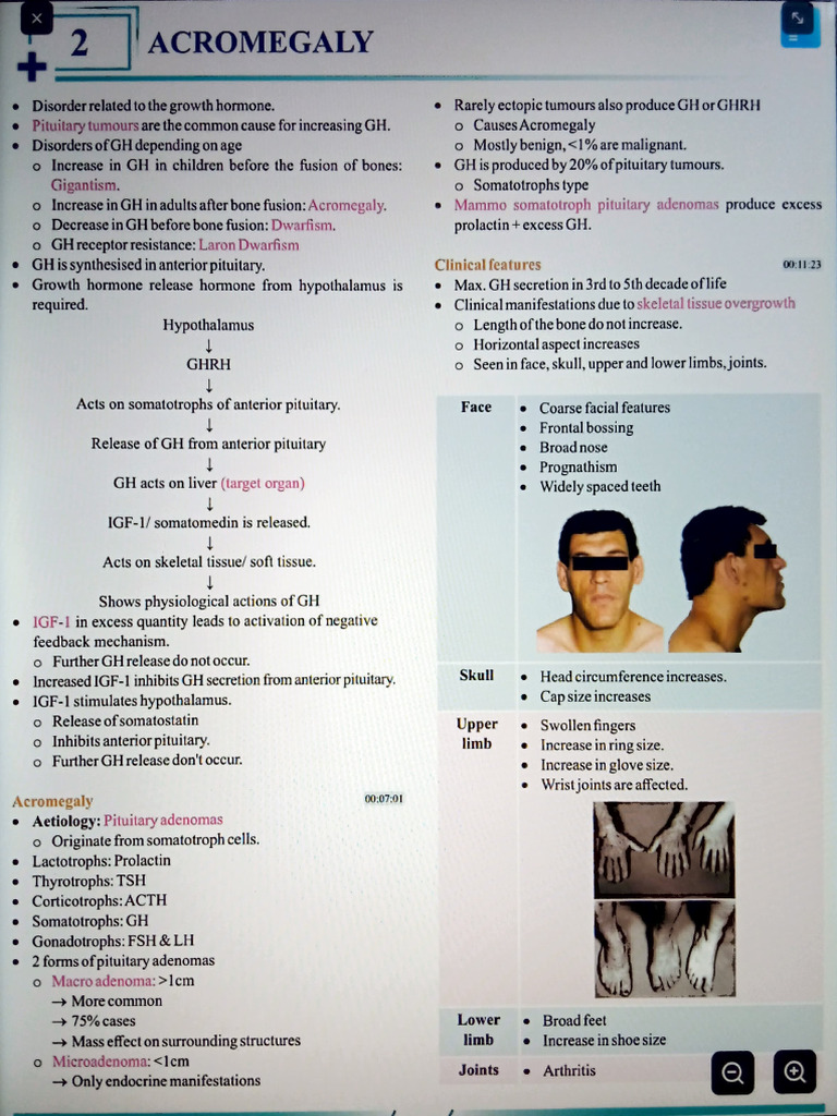 Acromegaly | PDF