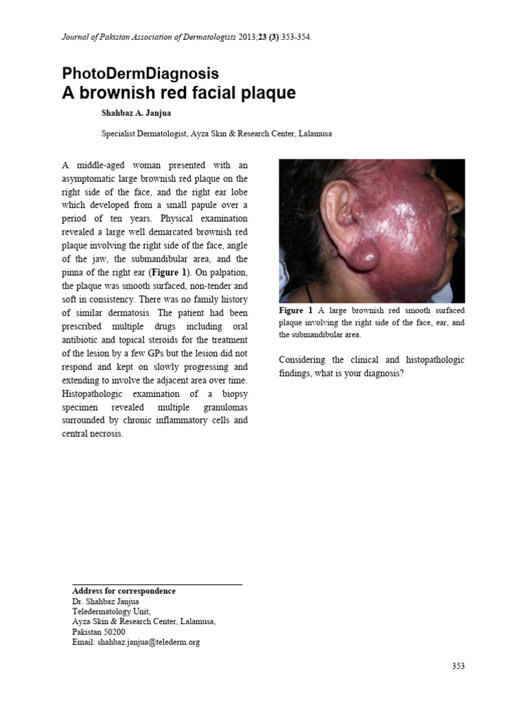 Lupus Vulgaris | PDF | Tuberculosis | Diseases And Disorders