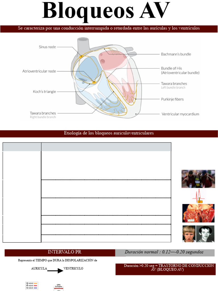 Tipos y características de bloqueos AV | PDF | Electrocardiografia ...