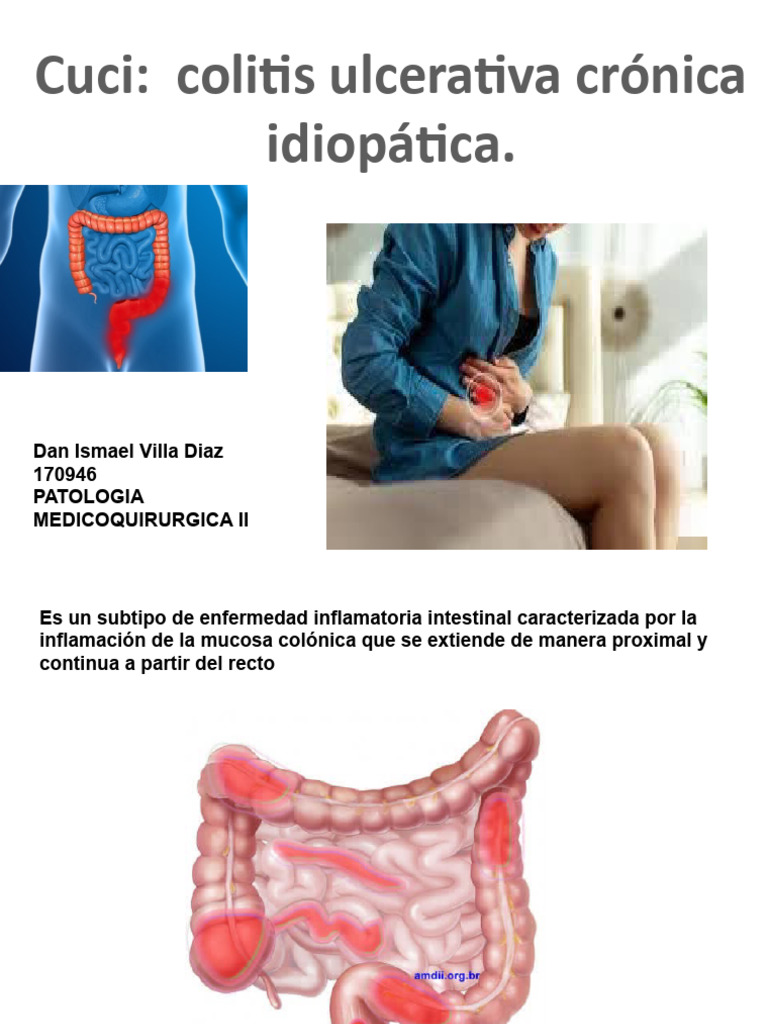Colitis Ulcerativa: Causas y Tratamientos | PDF | Colitis ulcerosa ...