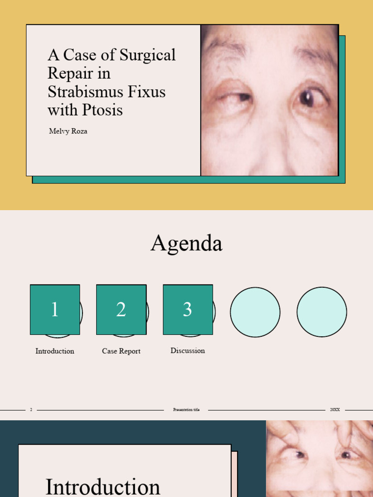 A Case of Surgical Repair in Strabismus Fixus | PDF | Ophthalmology | Human Eye