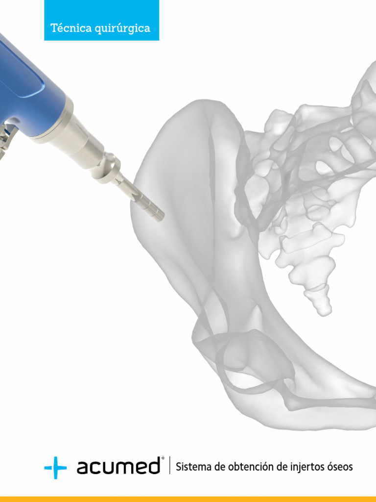 Acumed Surgical Technique ES Bone Graft Harvesting System ESBIO00 03 A ...
