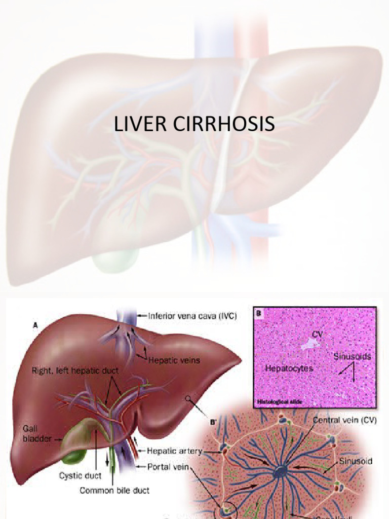 Cirrhosis | Download Free PDF | Cirrhosis | Liver
