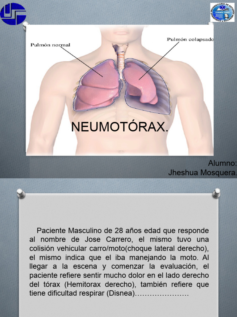 Neumotorax | PDF | Respiración | Medicina CLINICA