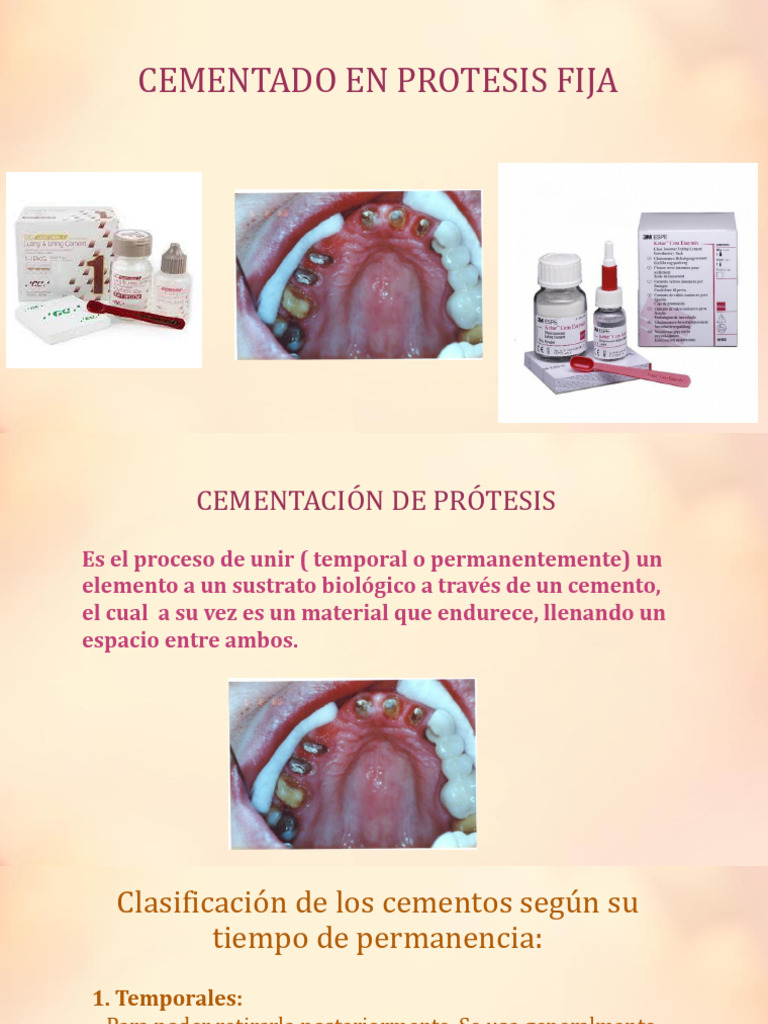 Clase de Cementado en Protesis Fija 2024 | PDF | Cemento | Materiales