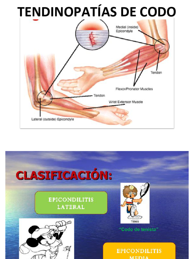 Tendinopatias Del Codo | PDF | Medicina CLINICA | Enfermedades y trastornos