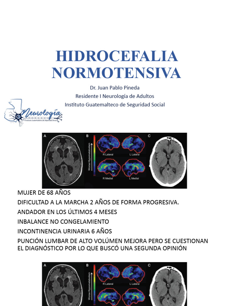 Hidrocefalia Normotensiva | PDF | Fluido cerebroespinal | Enfermedades ...