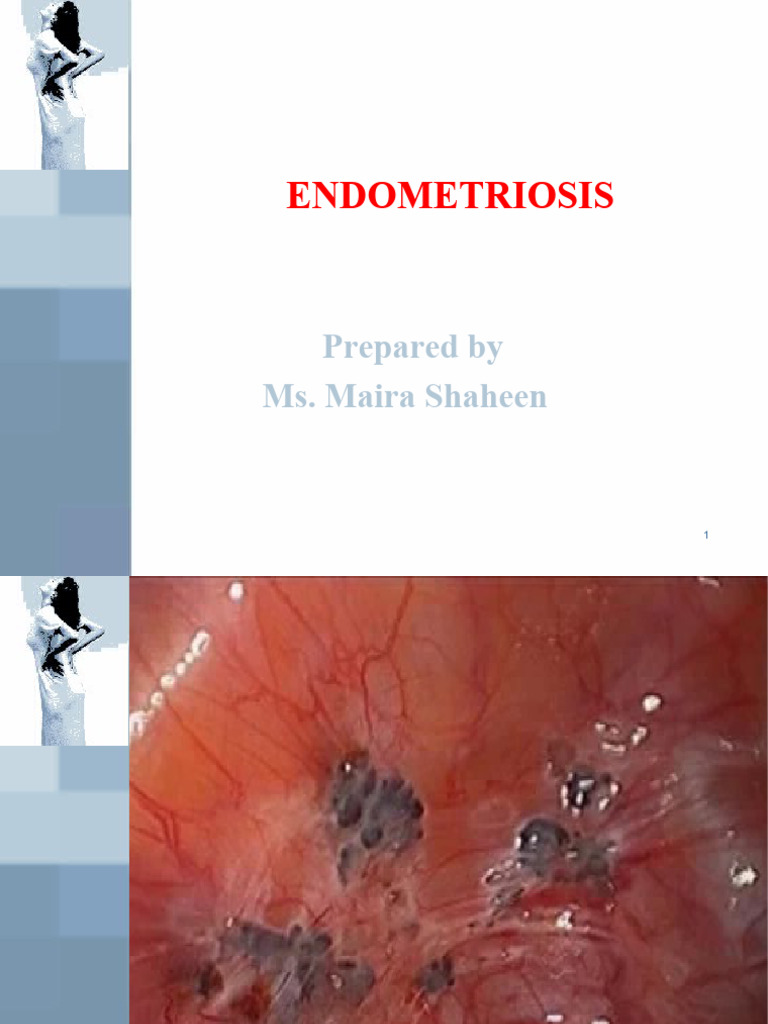 Understanding Endometriosis: Causes & Management | PDF | Diseases And ...