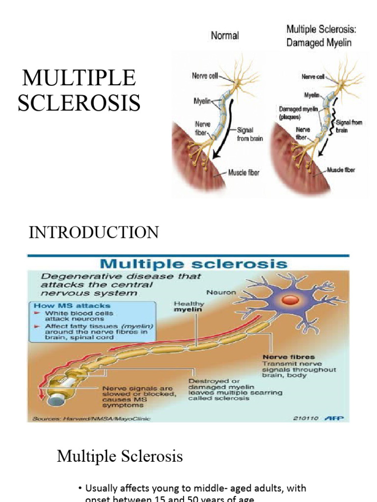 Multiple Sclerosis | PDF | Myelin | Multiple Sclerosis
