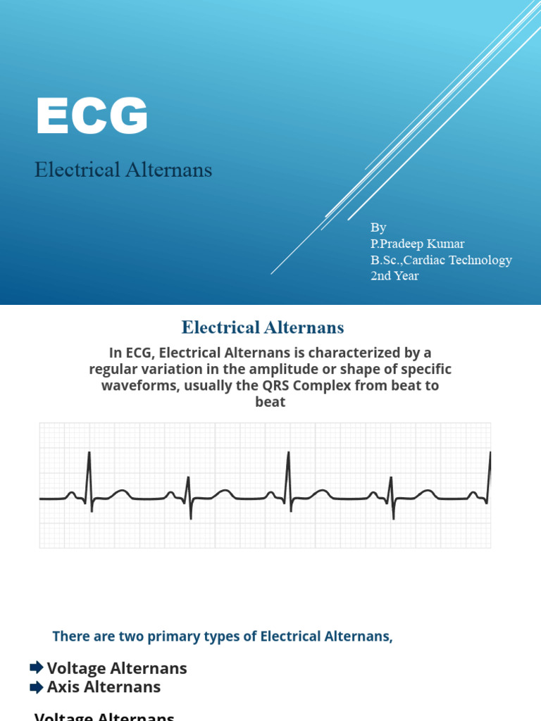 ECG-Electrical Alternans | PDF