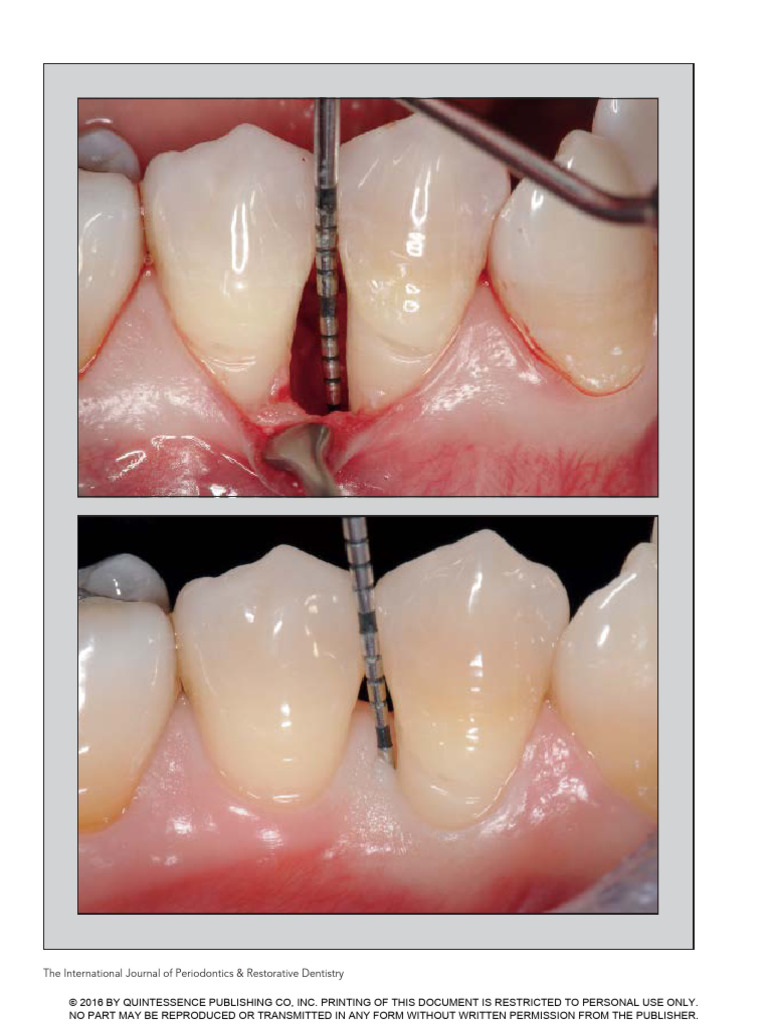 11) Minimally Invasive Surgical Technique in Periodontal Regeneration ...