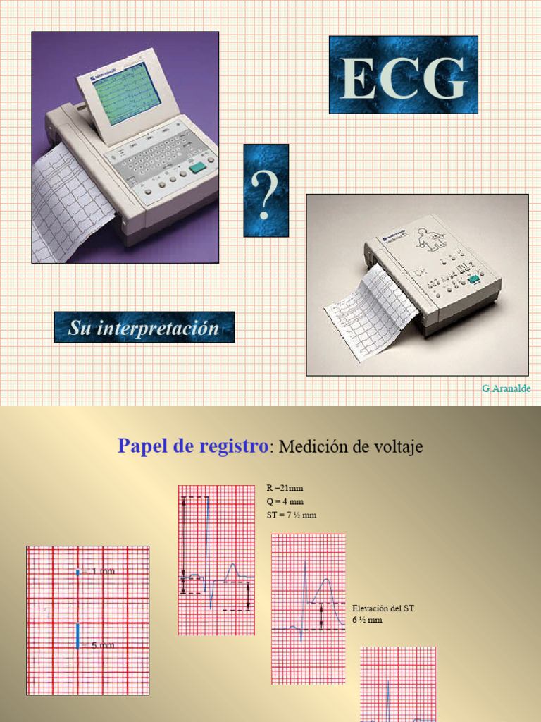 Interpretación y Análisis del ECG | PDF | Electrocardiografia ...