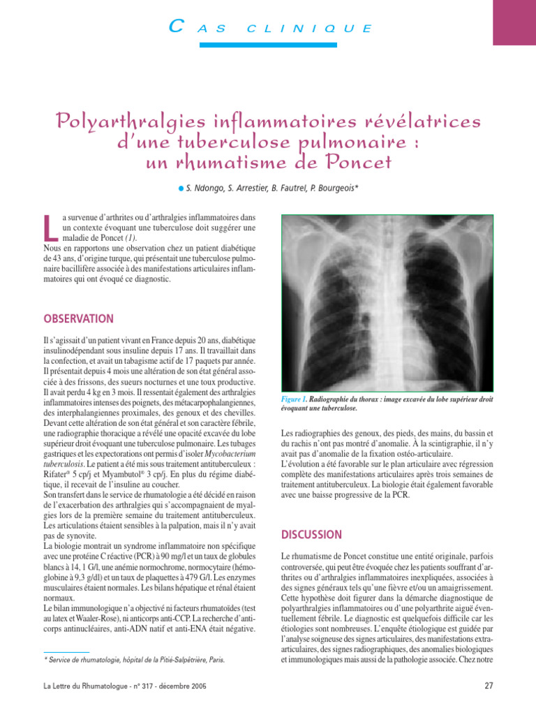 Maladie de Poncet - Polyarthralgies Tuberculeuse | PDF | Tuberculose ...