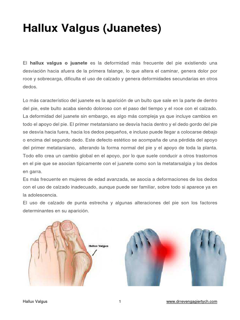 Causas y Tratamientos del Hallux Valgus | PDF | Dedo del pie | Medicina ...