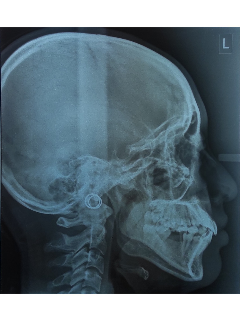 Contoh Rontgen Sefalo | PDF