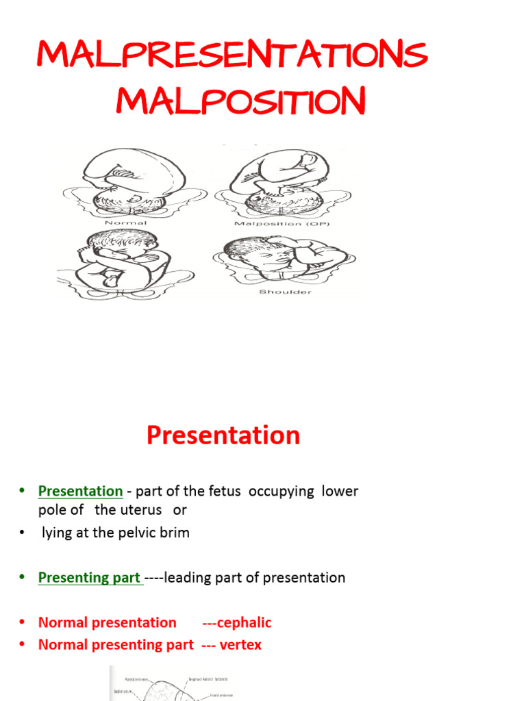 ?15. Malposition & Malpresentation (New) | PDF | Childbirth | Pelvis