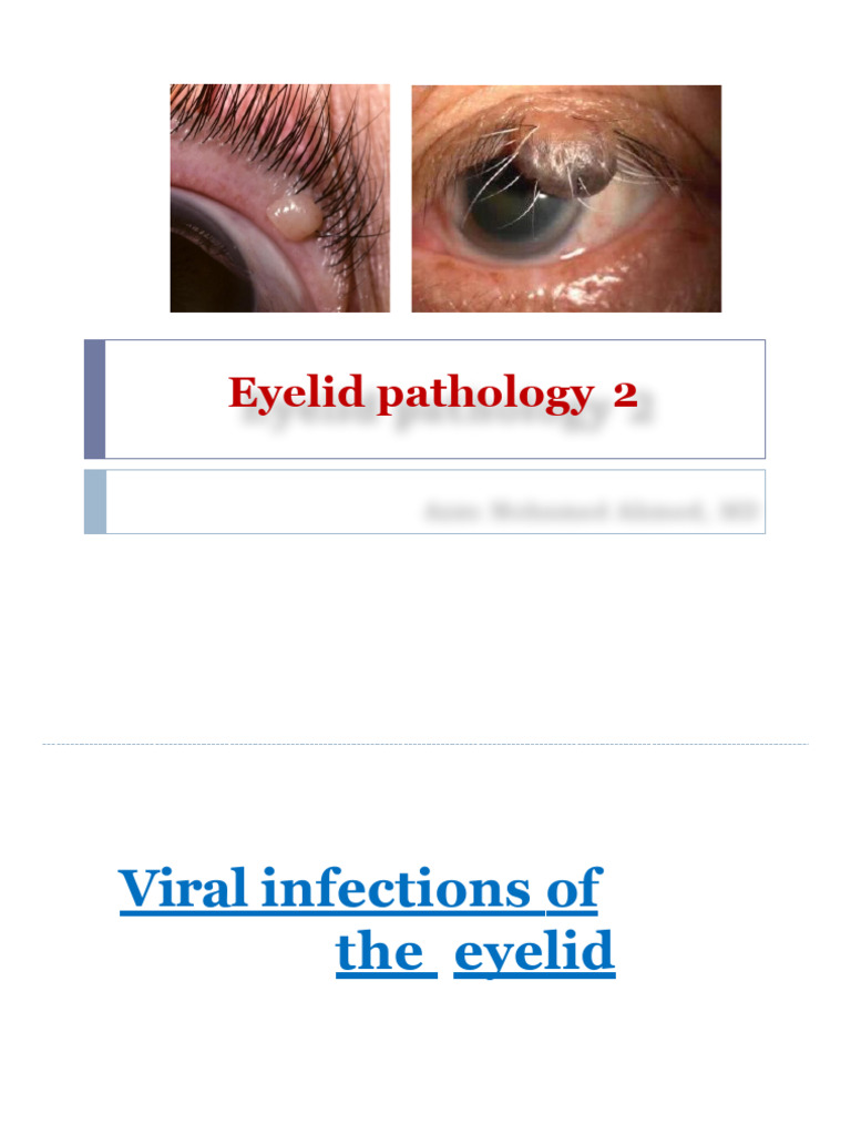 Eyelid Pathology 2 | Download Free PDF | Neoplasms | Melanoma