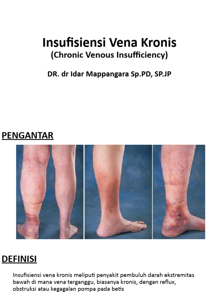 Insufisiensi Vena Kronis: Gejala dan Tatalaksana | PDF | Sains & Matematika