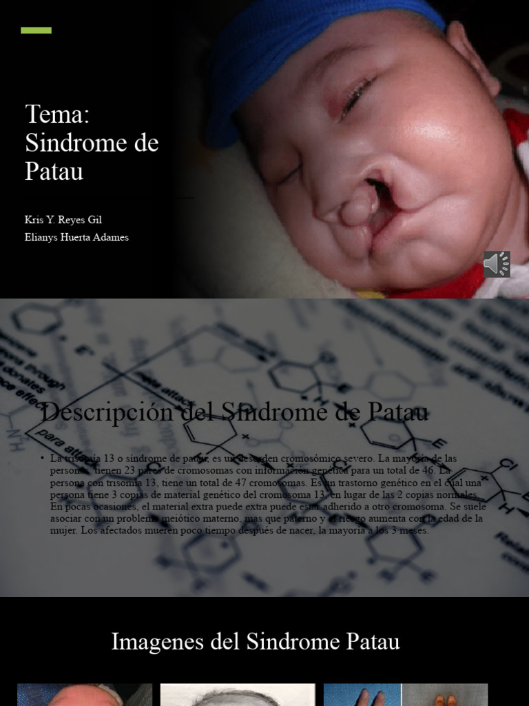 Tema Sindrome de Patau 2 | PDF | Ciencia y matemáticas