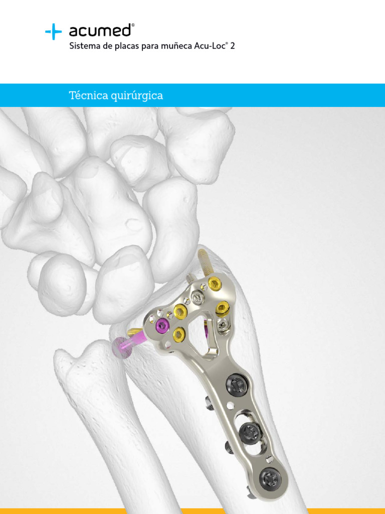 Acumed-Surgical-Technique-ES-Acu-Loc-2-ESHNW00-06-C | PDF | Tornillo
