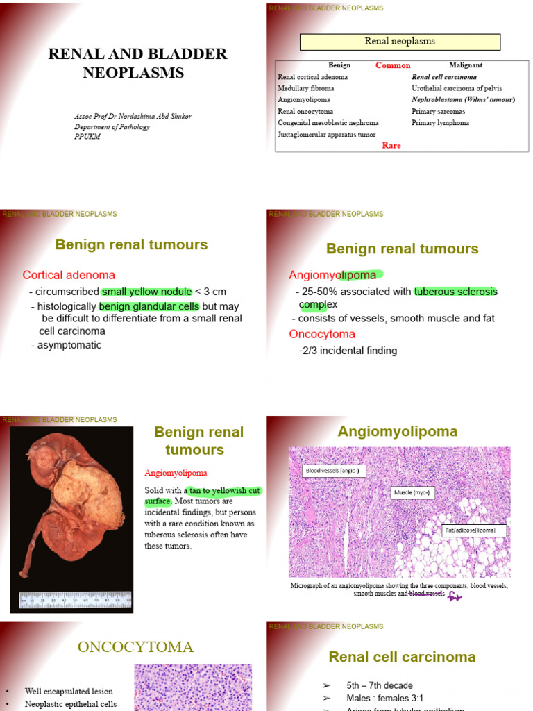 CL13 - Neoplasm of Renal - Bladder | PDF | Causes Of Death | Clinical Medicine