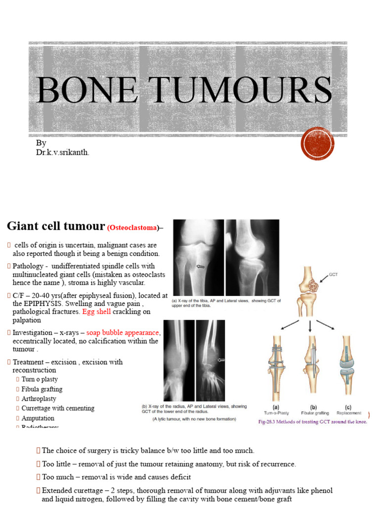 Bone Tumours | PDF