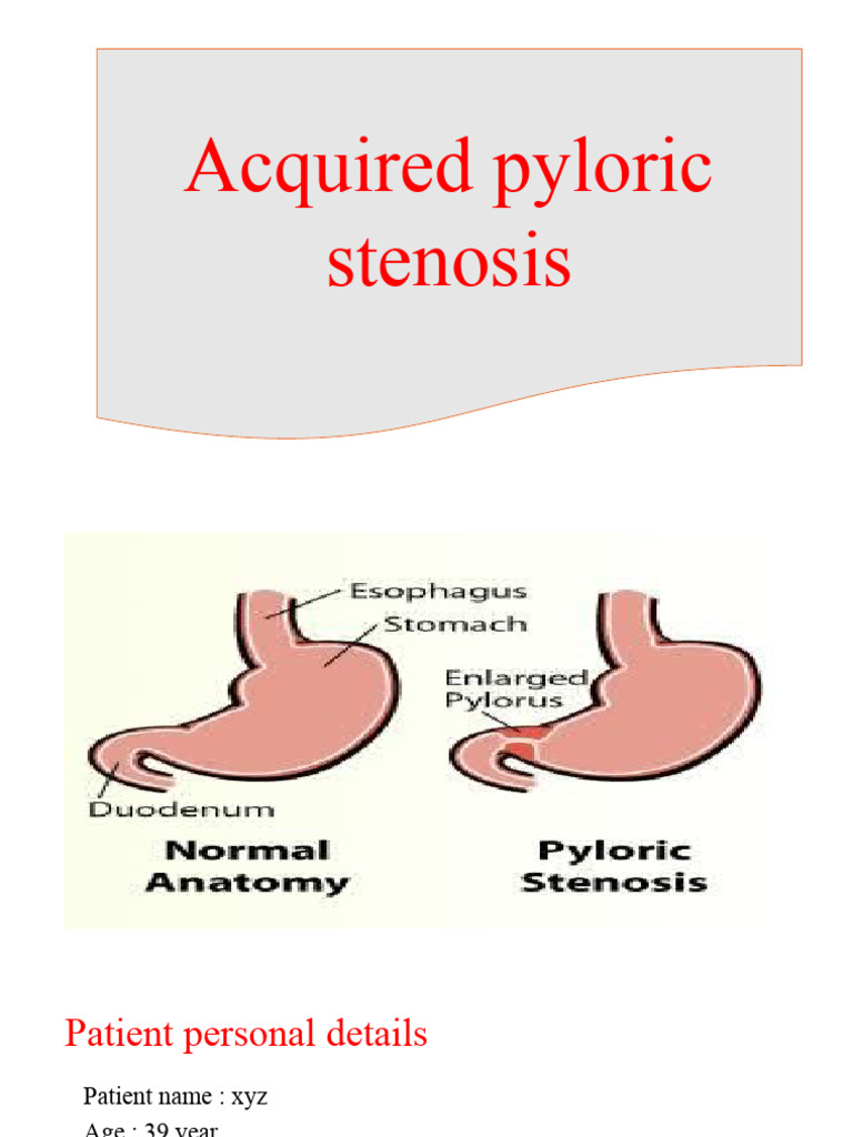 Medical Case: Pyloric Stenosis | PDF | Medical Specialties ...