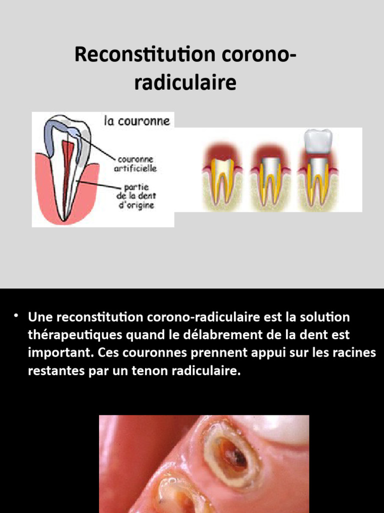 Reconstitution corono-radiculaire dentaire | PDF | Dent | Bouche