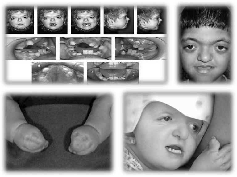 SÍNDROME DE APERT Imagenes | PDF