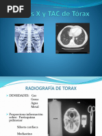 Radiografía de Tórax Normal - Patrón Intersticial | PDF | Pulmón | Tórax