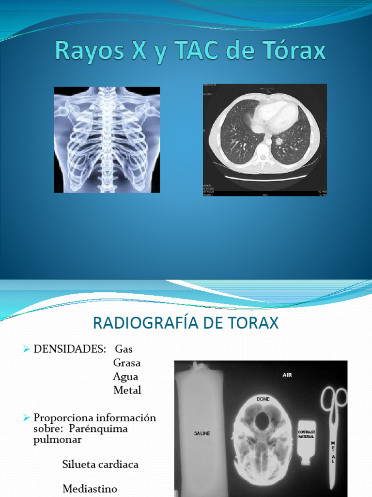 Interpretación Rayos X y Tac Tórax | PDF | Tórax | Pulmón
