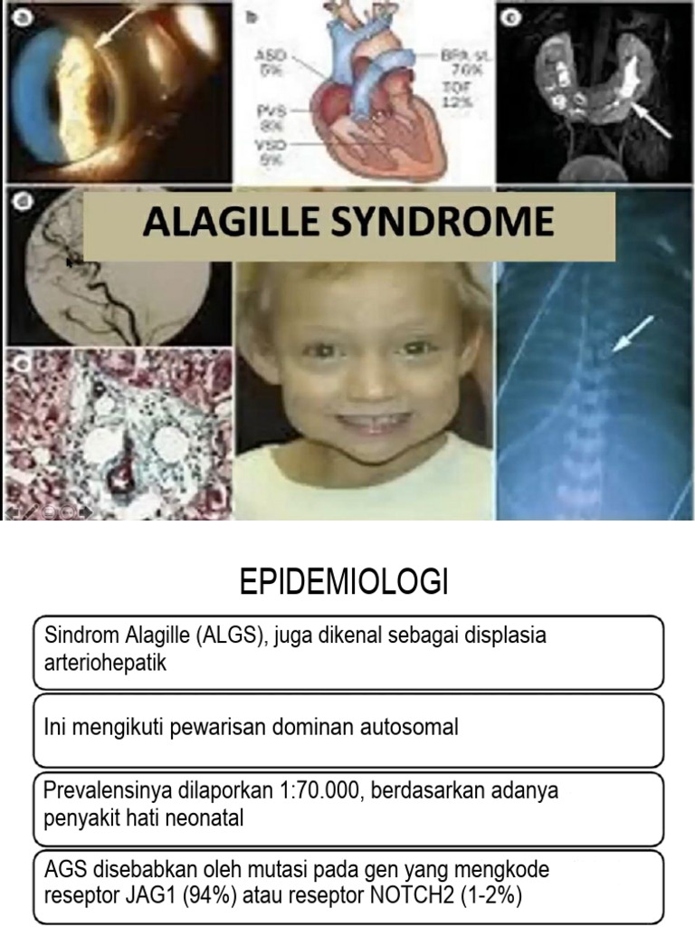 Epidemiologi Sindrom Alagille | PDF