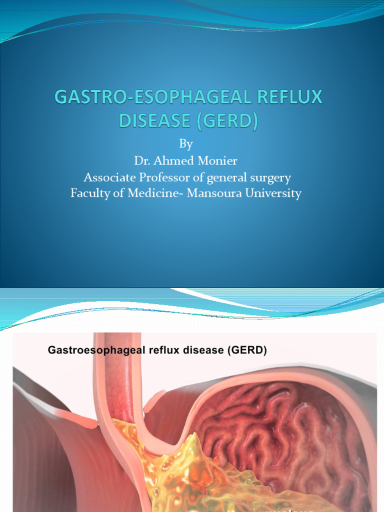 Gerd | PDF | Gastroesophageal Reflux Disease | Esophagus