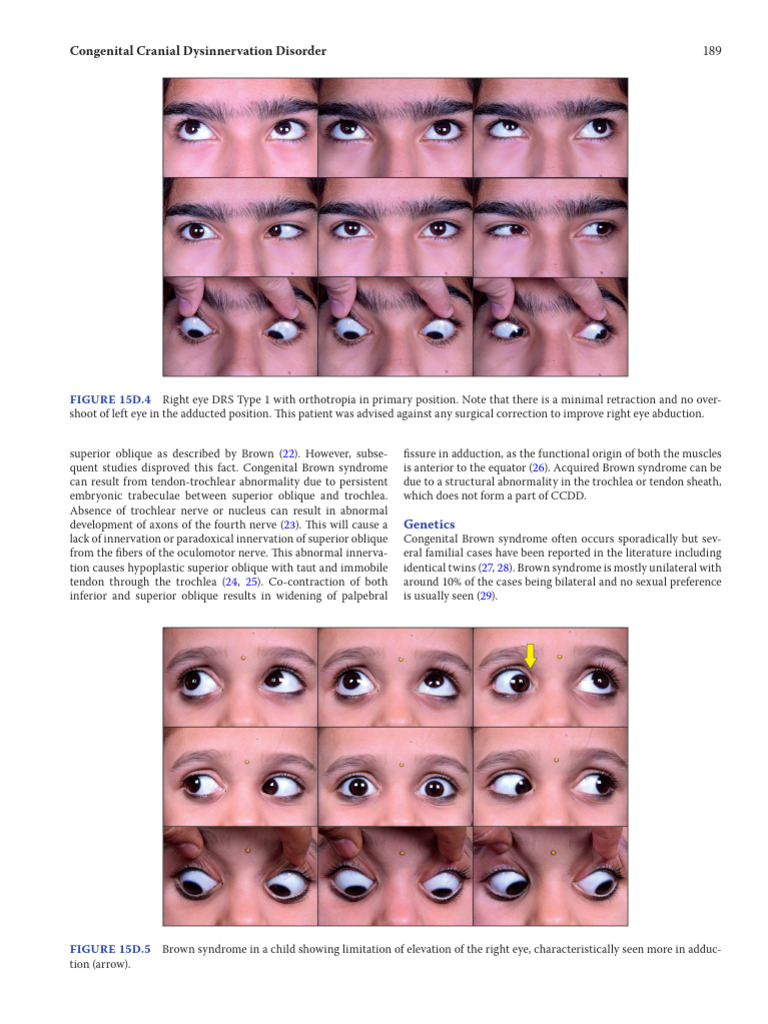 A Clinical Approach to Neuro-Ophthalmic Disorders | PDF | Human Anatomy ...