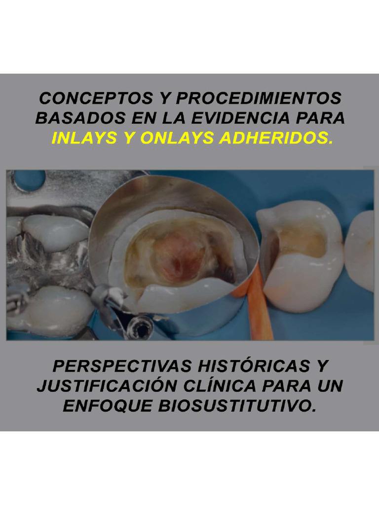 Conceptos y Procedimientos Basados en La Evidencia para Inlays y | PDF